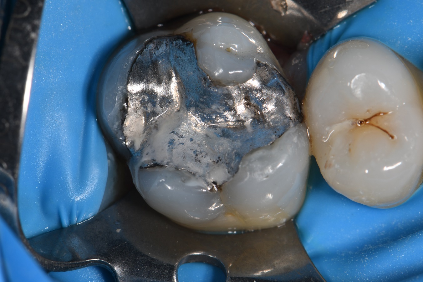 G-aenial Achord Large Amalgam Replacement