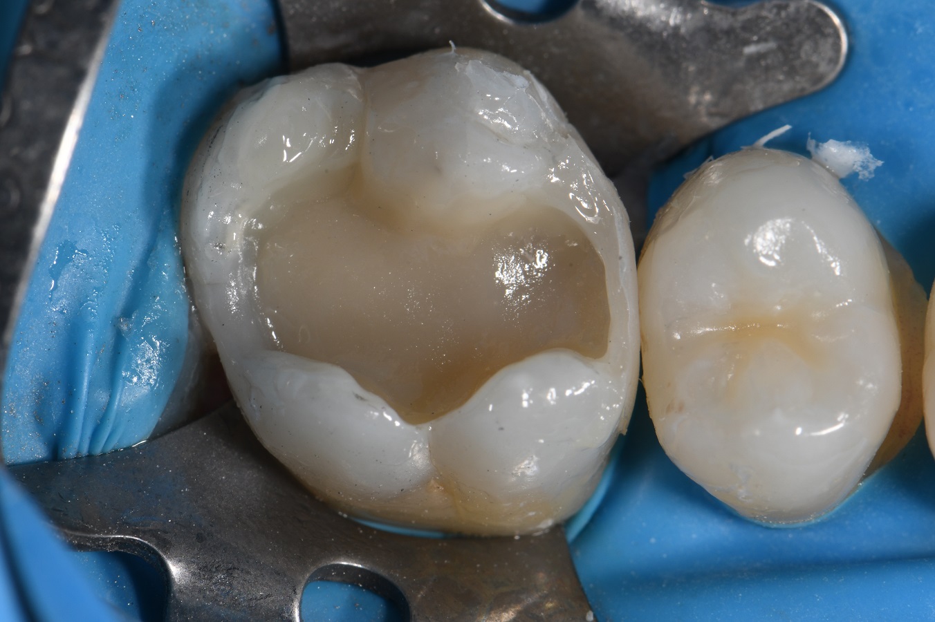 G-aenial Achord Large Amalgam Replacement