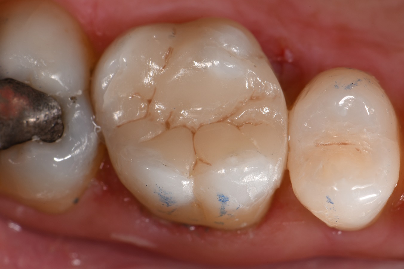 G-aenial Achord Large Amalgam Replacement