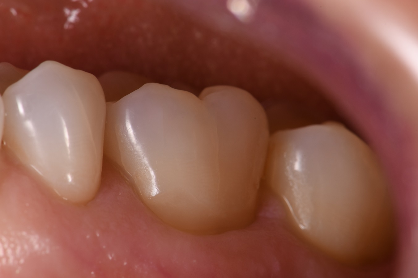 Cervical Abrasion On Bleached Patient Cervical Abrasion On Bleached Patient