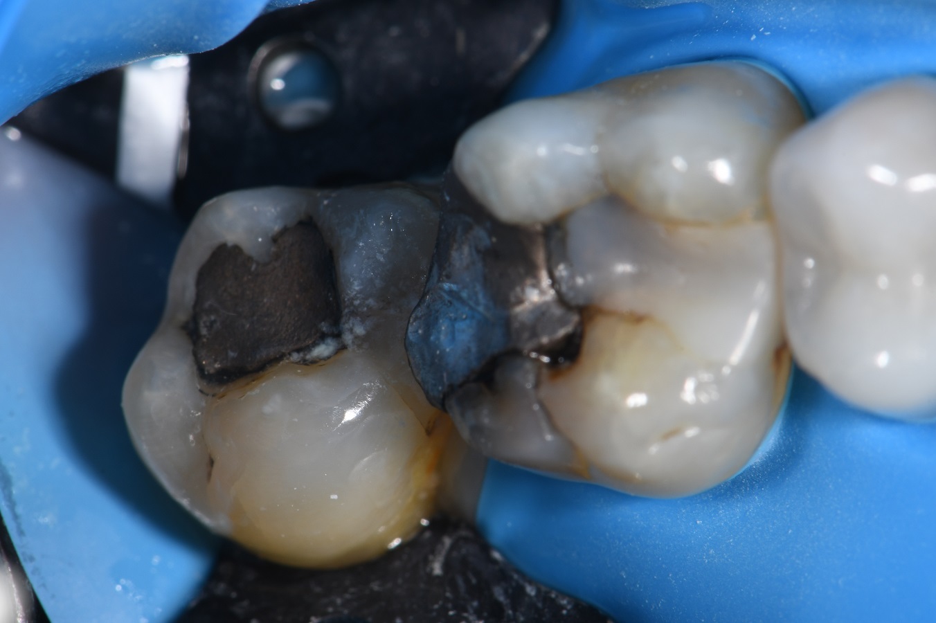 Large Amalgam Restoration Replacements | Kerr Simplishade