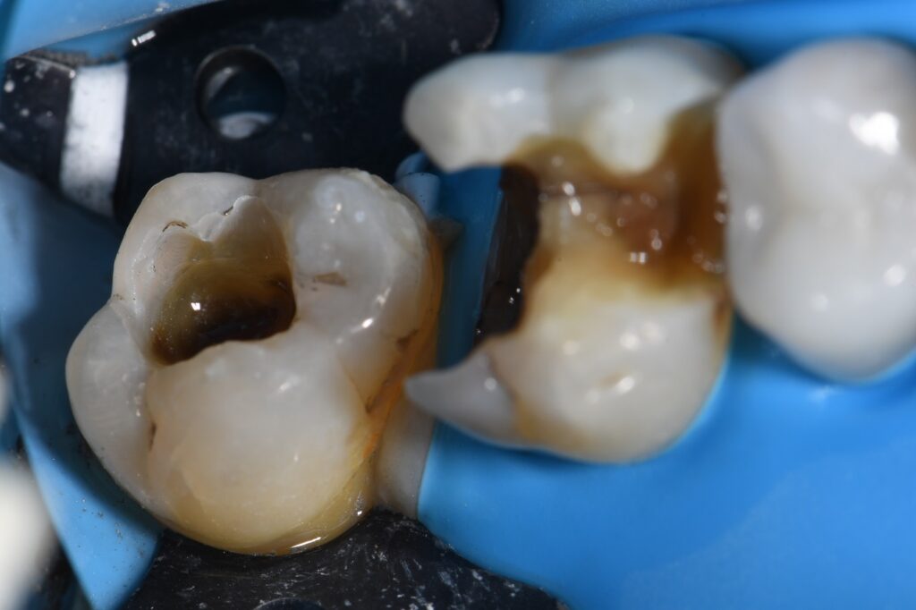 Large Amalgam Restoration Replacements | Kerr Simplishade