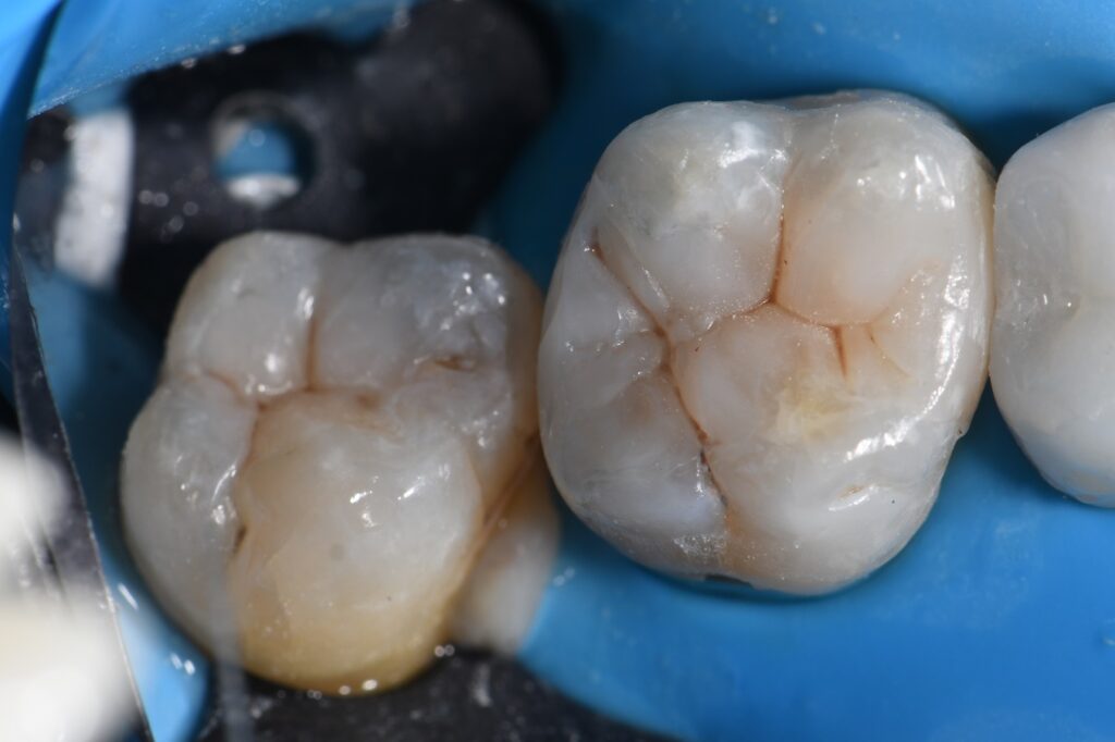 Large Amalgam Restoration Replacements | Kerr Simplishade