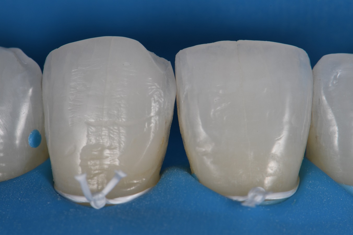 Post Orthodontic Composite Bonding Post Orthodontic Composite Bonding