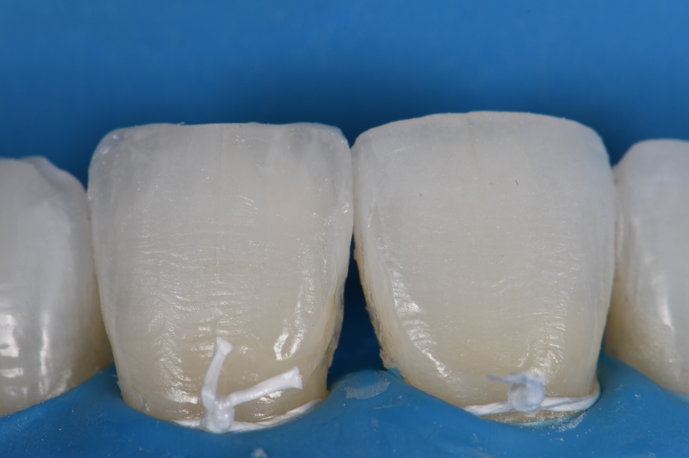 Post Orthodontic Composite Bonding Post Orthodontic Composite Bonding