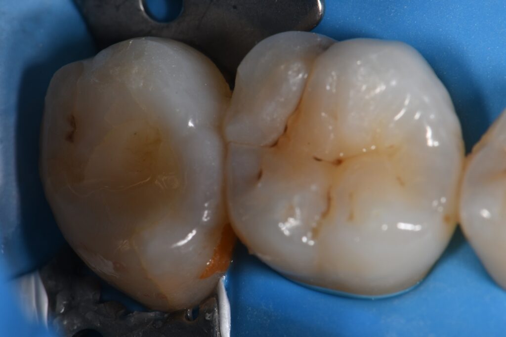 Ingot Selection for Endodontically Treated Teeth