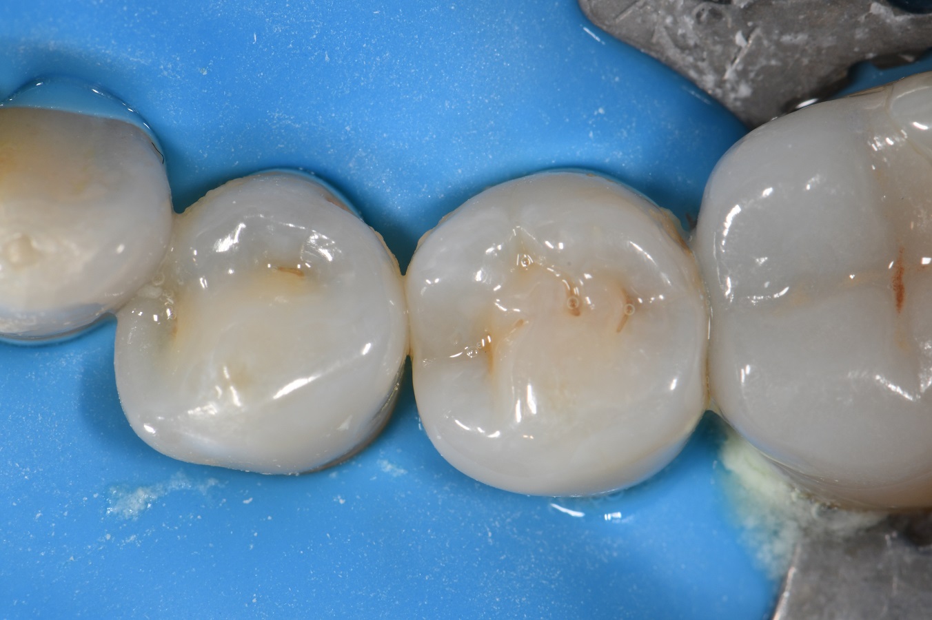 Slot Prep with Detailed Composite Resin