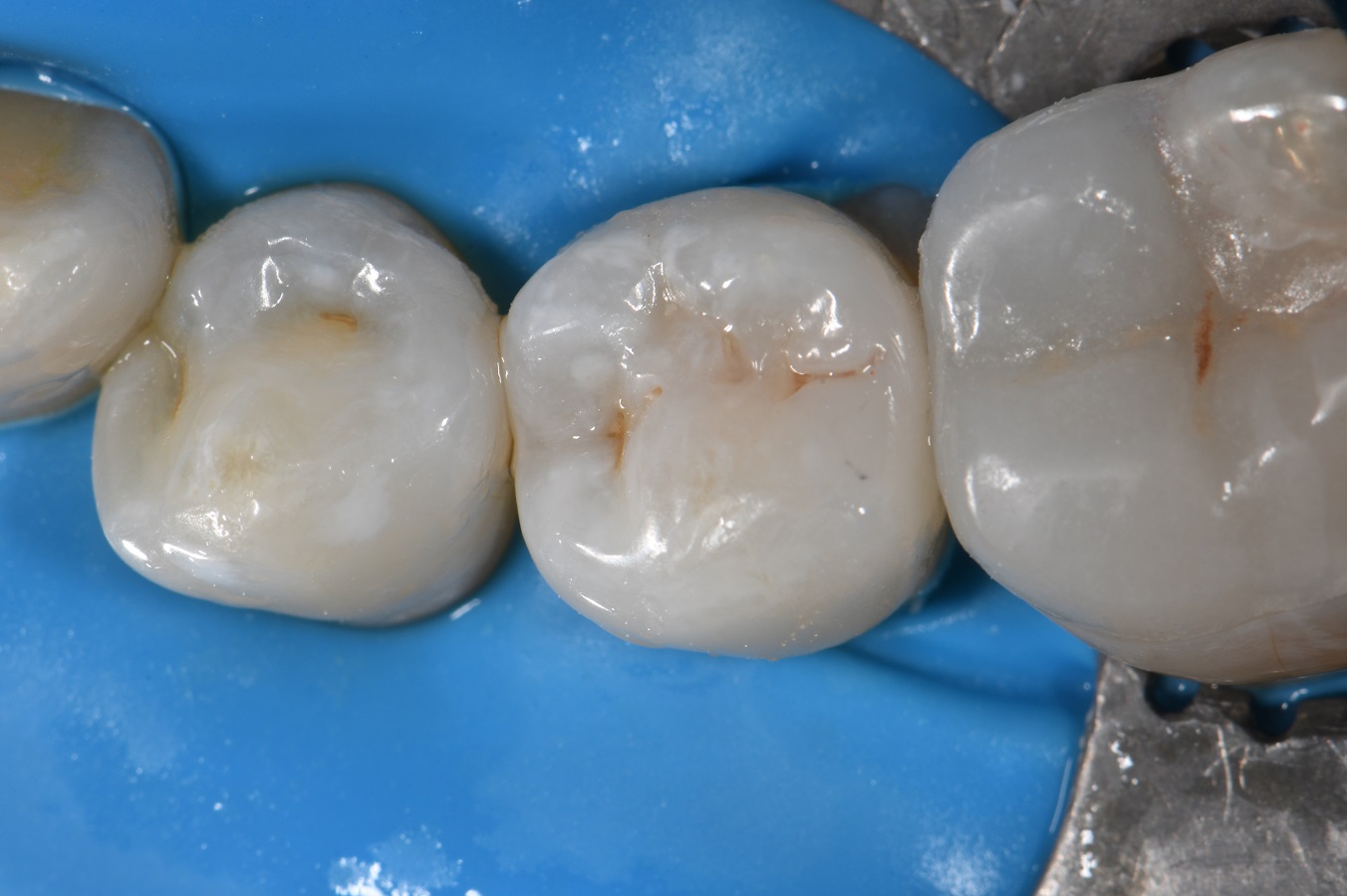 Slot Prep with Detailed Composite Resin