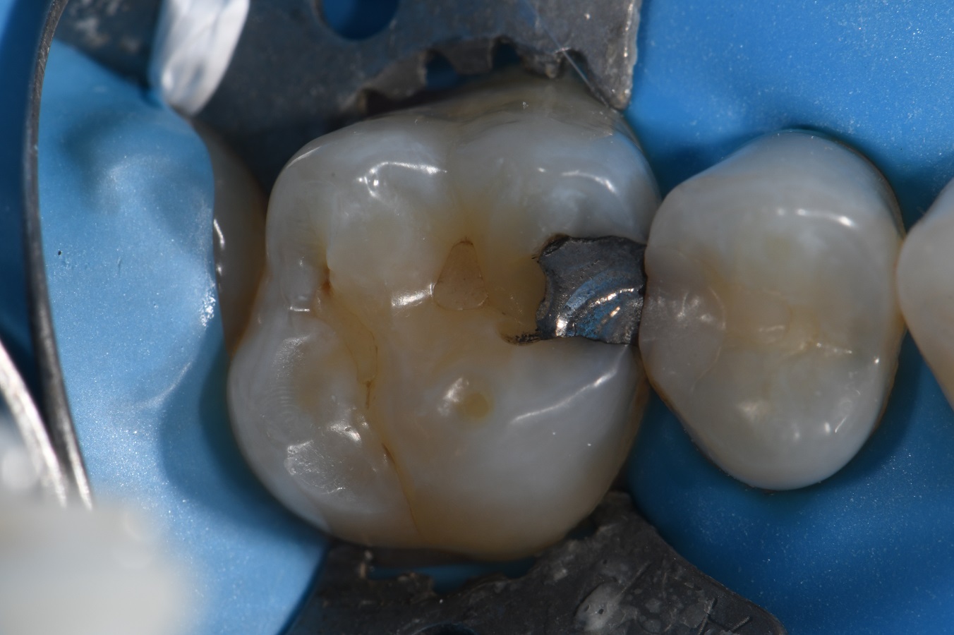 Marginal ridge reconstruction in composite