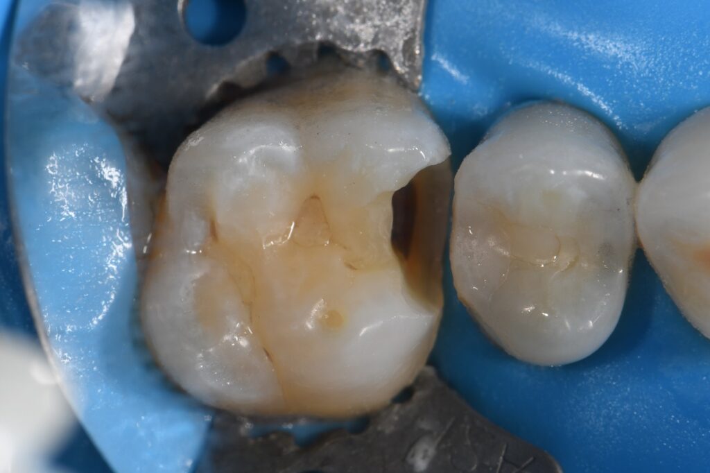 Marginal ridge reconstruction in composite