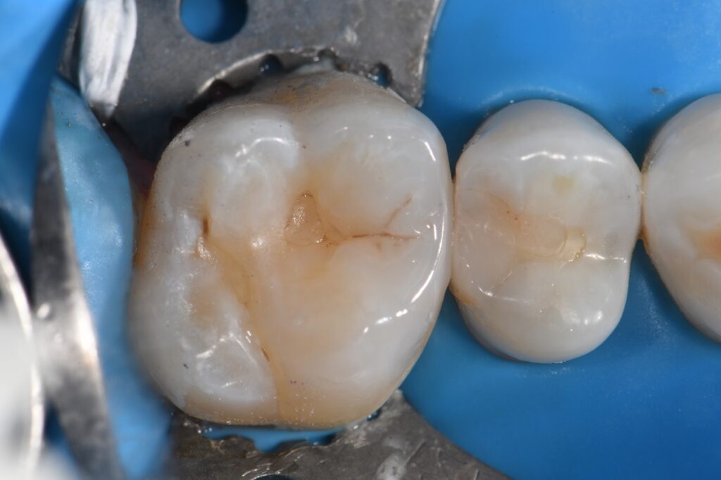 Marginal ridge reconstruction in composite