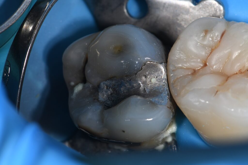 Large Molar Composite Restorations Large Molar Composite Restorations