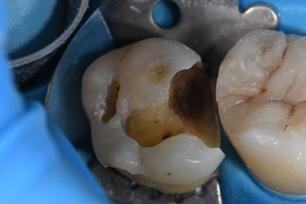Large Molar Composite Restorations Large Molar Composite Restorations