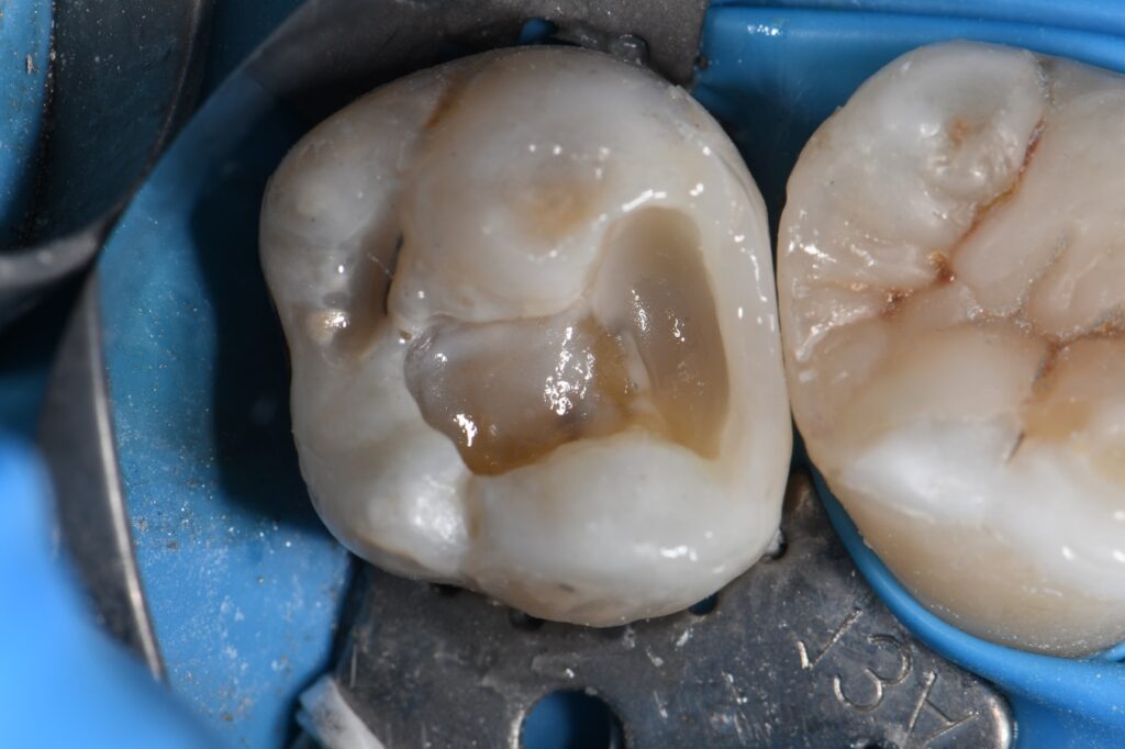 Large Molar Composite Restorations Large Molar Composite Restorations