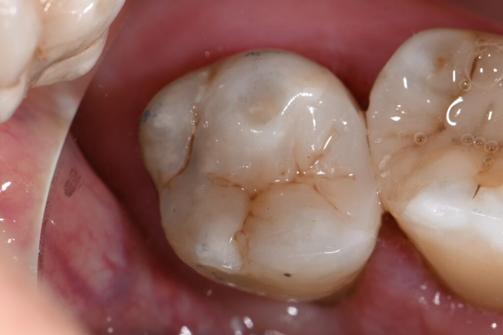 Large Molar Composite Restorations Large Molar Composite Restorations