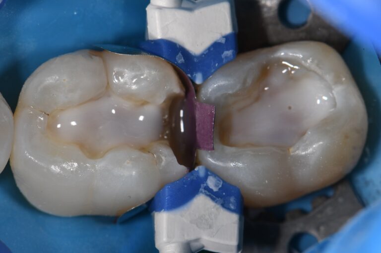 Garrison Compositight 3D Fusion | Marginal Leakage