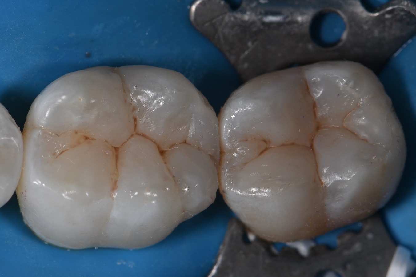 Garrison Compositight 3D Fusion | Marginal Leakage