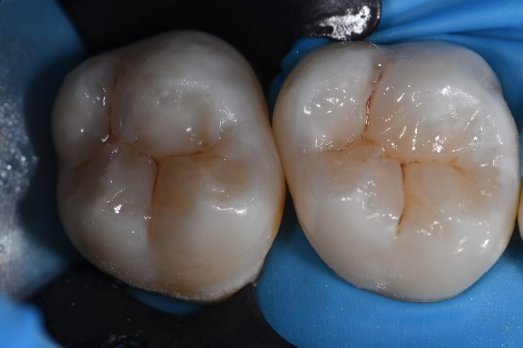 Occlusopalatal Composite Restorations Occlusopalatal Composite Restorations