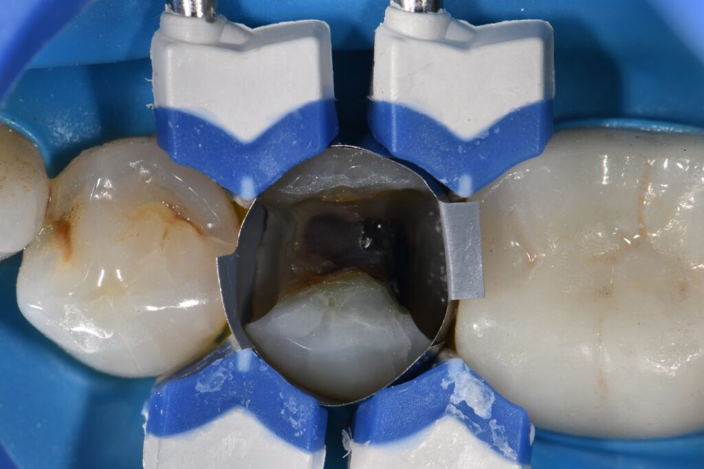 Amalgam Removal and Composite Resin Replacement
