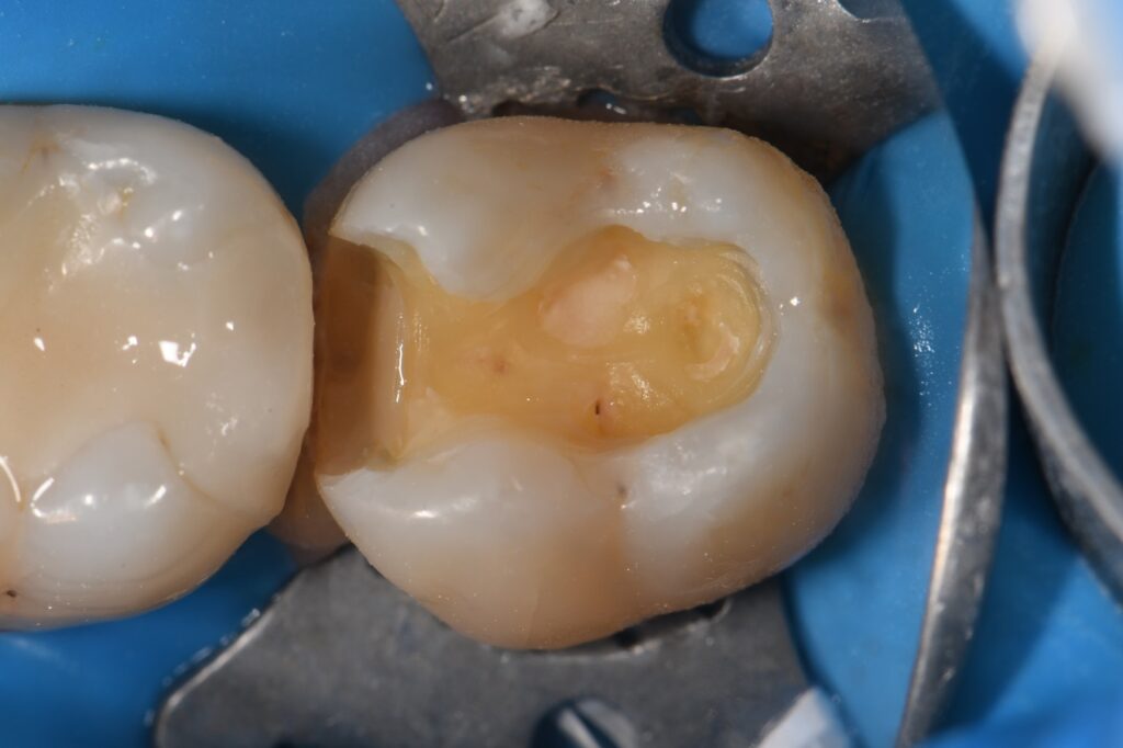 Molar Class II Kerr Simplishade