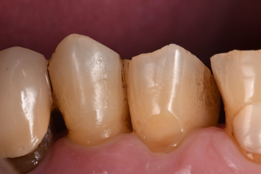 Class V full silanated composite resin Class V full silanated composite ...