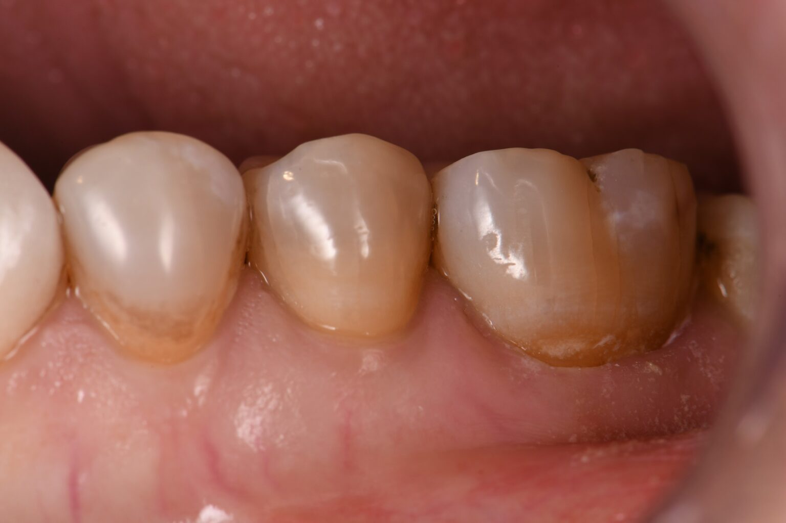 Cervical Abrasion Reversal Composite Restorations Cervical Abrasion ...