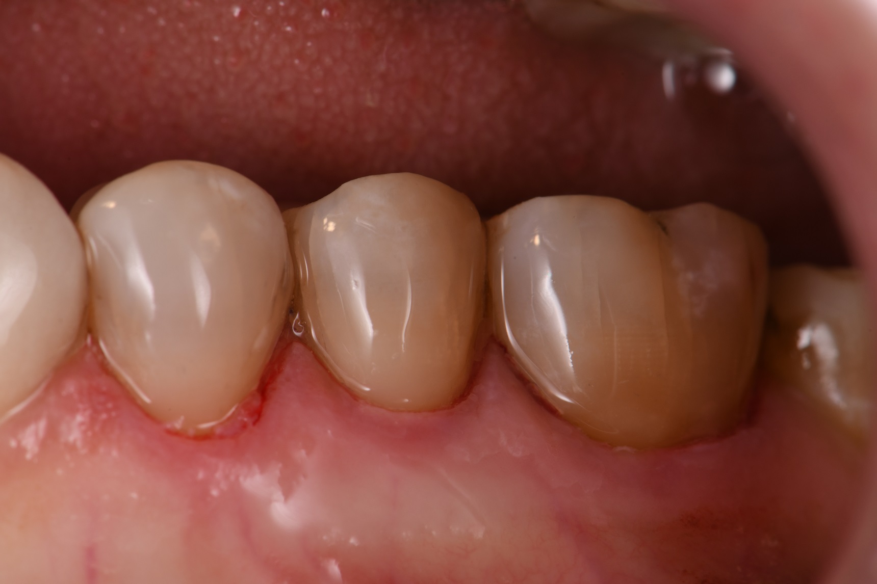 Cervical Abrasion Reversal Composite Restorations Cervical Abrasion ...