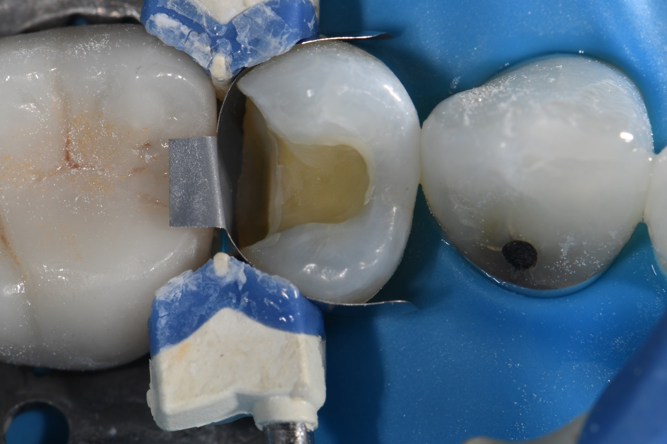Composite Fillings that look natural Composite Fillings that look natural