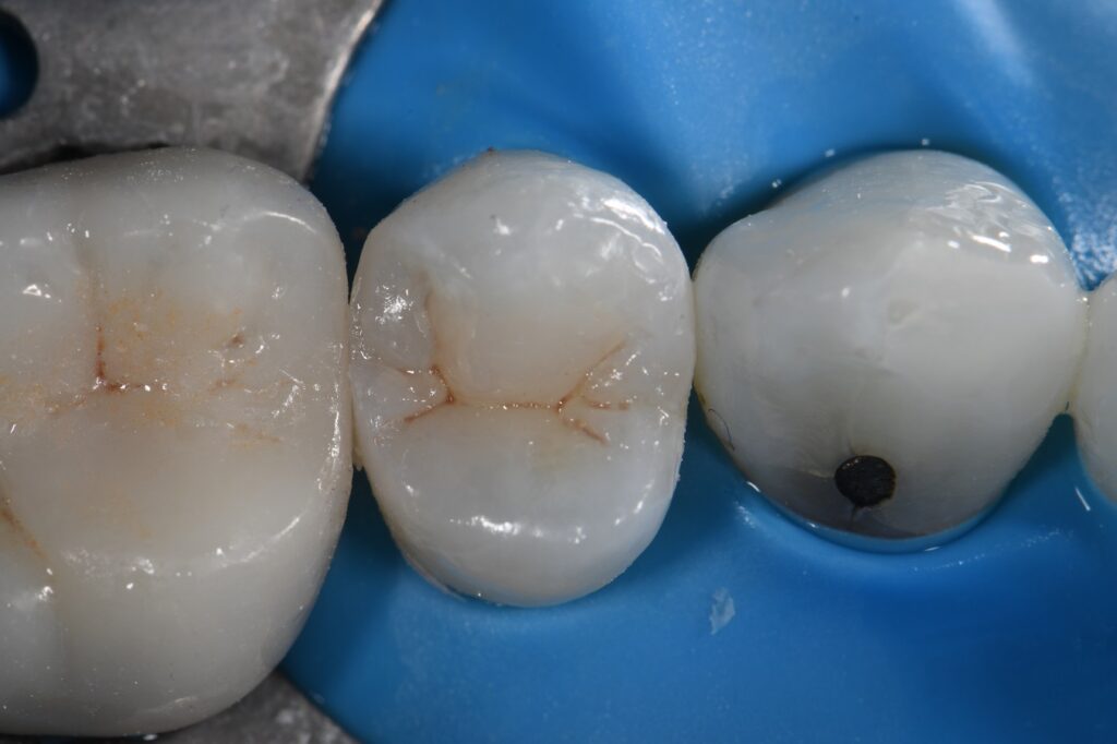 Composite Fillings that look natural Composite Fillings that look natural