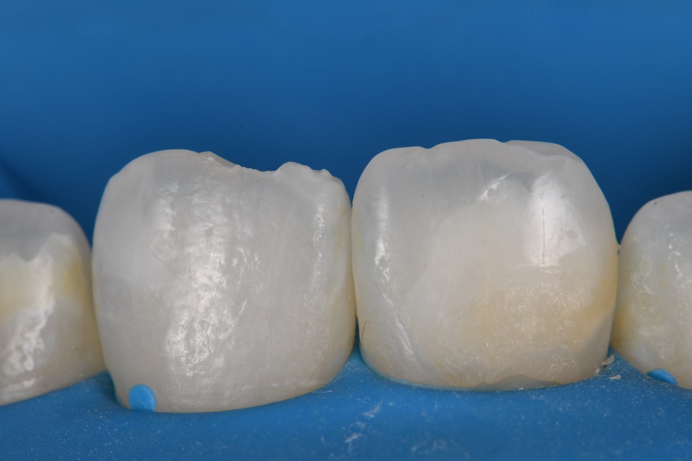 Edge Bonding on an Incisor with Hypomineralization