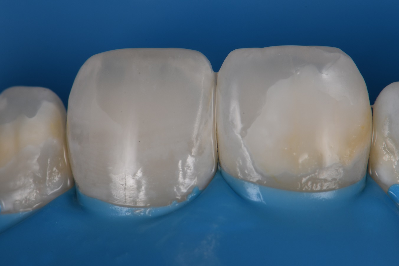 Edge Bonding on an Incisor with Hypomineralization