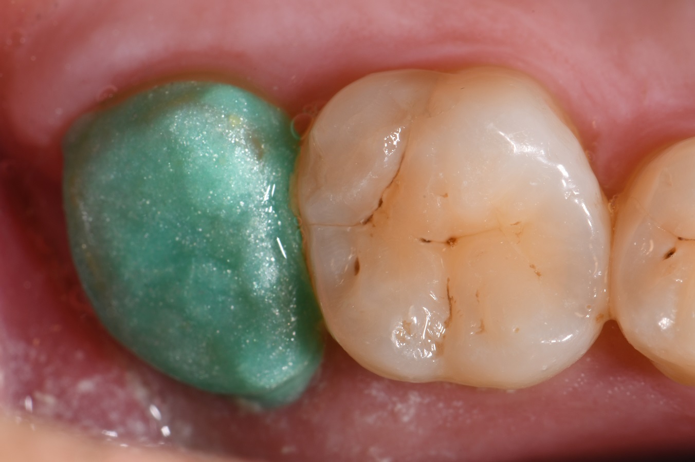 Ingot Selection for Endodontically Treated Teeth