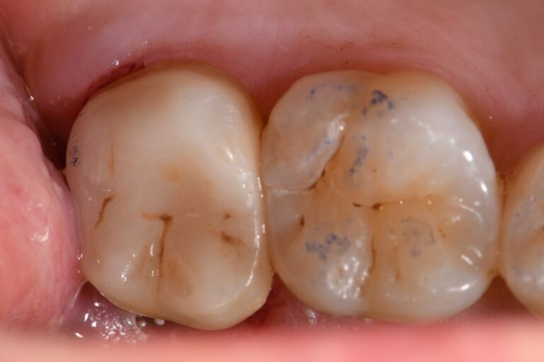 Ingot Selection for Endodontically Treated Teeth