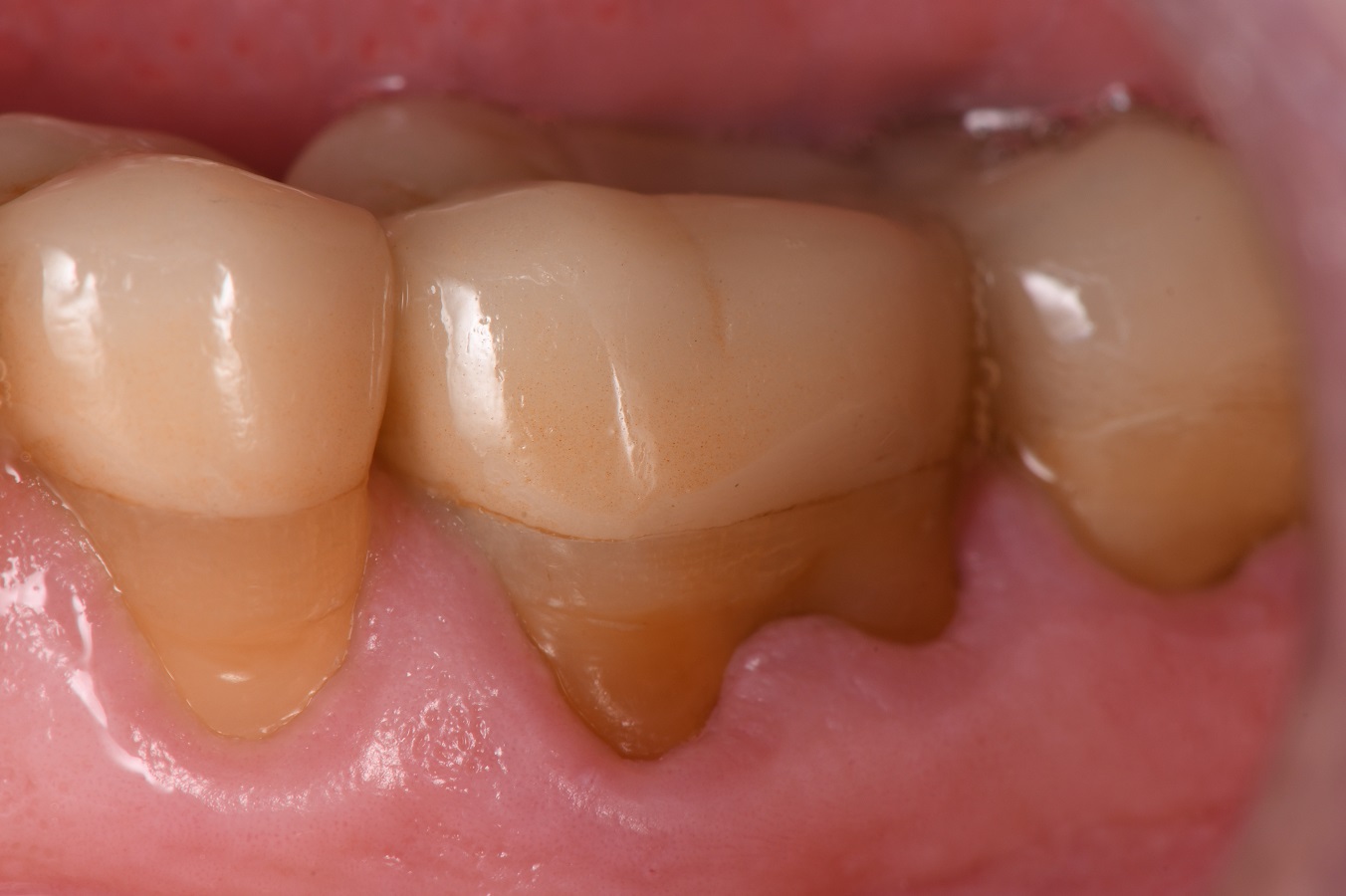 Radicular Abrasion Lesions Protected Radicular Abrasion Lesions Protected