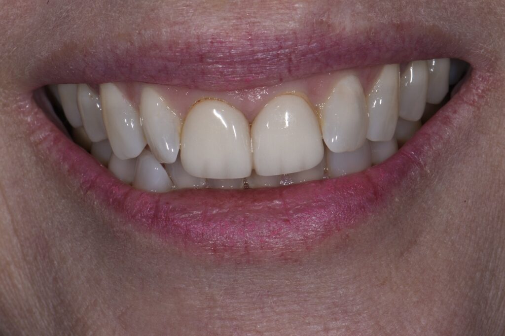 Transitional Composite Veneers Transitional Composite Veneers