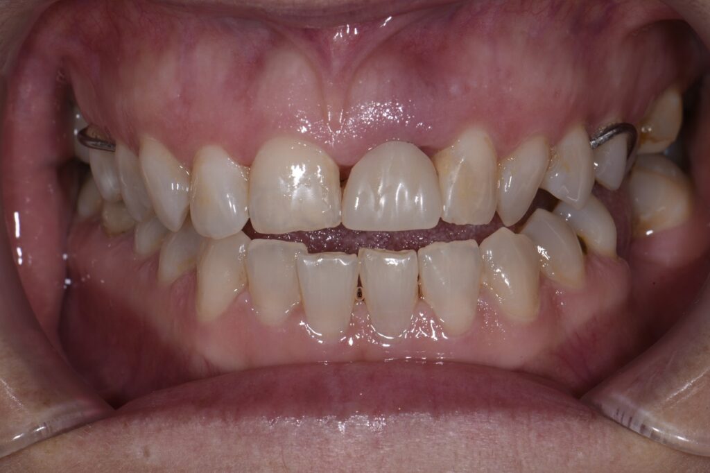 SureSmile | Smile Designer Pro | Veneers and Implant Crowns