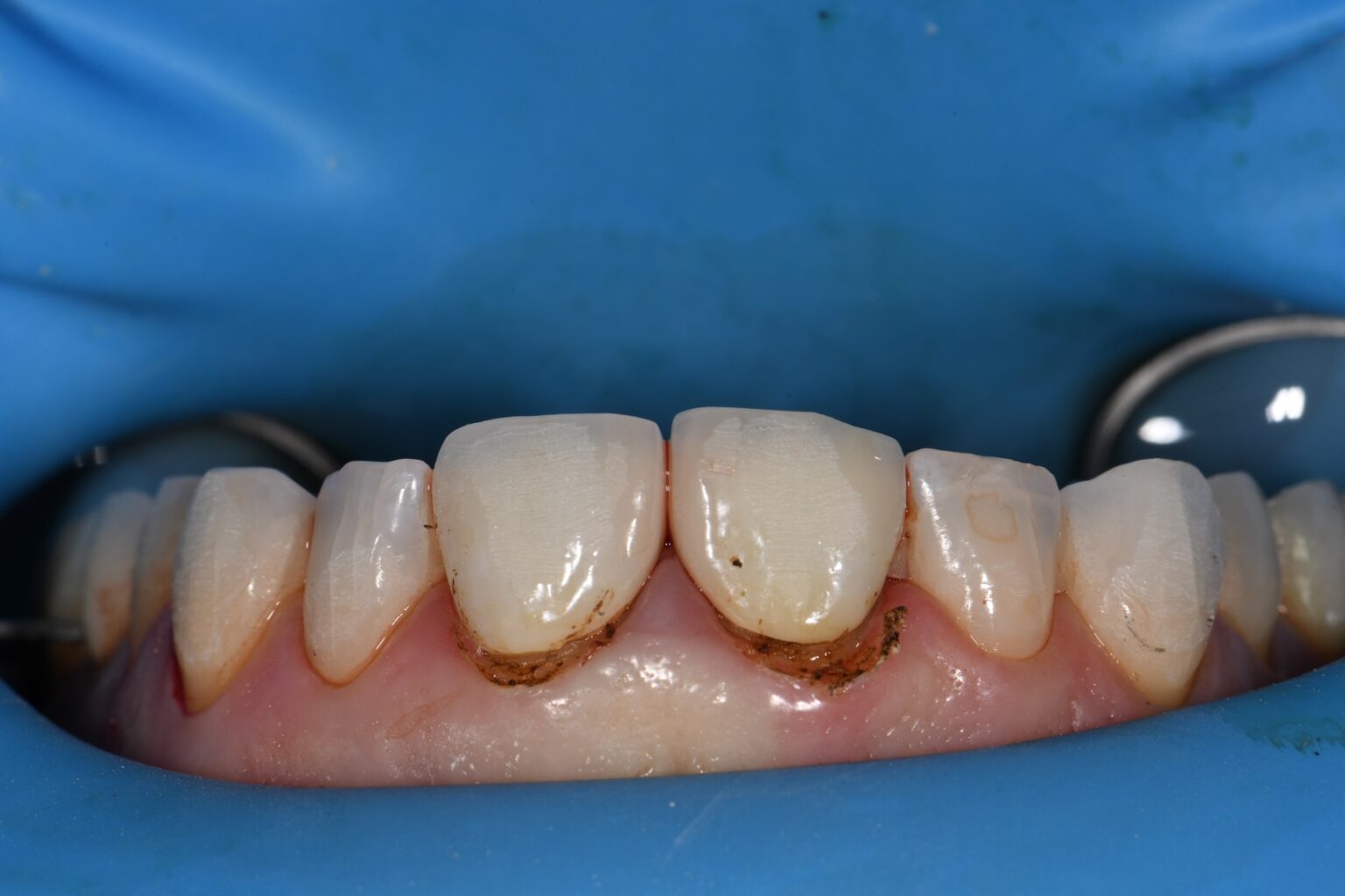 Porcelain Veneer Makeover Workflow Porcelain Veneer Makeover Workflow