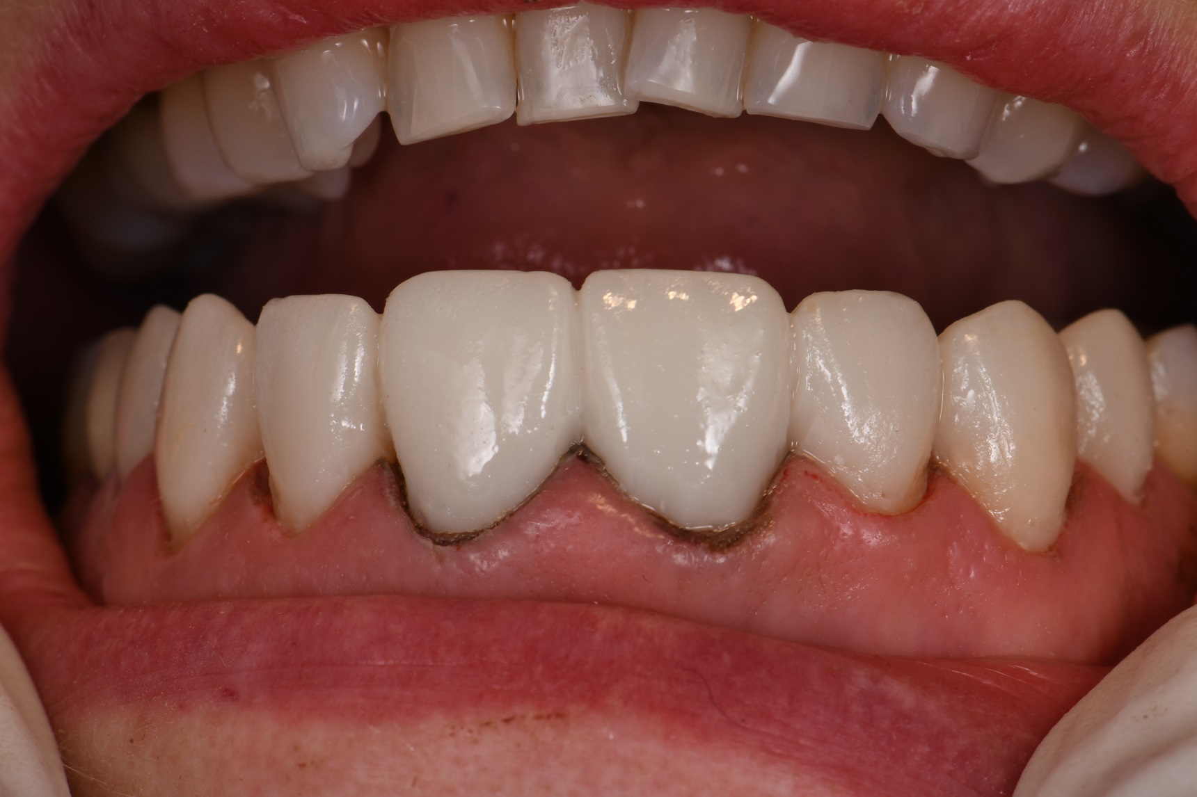 Porcelain Veneer Makeover Workflow Porcelain Veneer Makeover Workflow