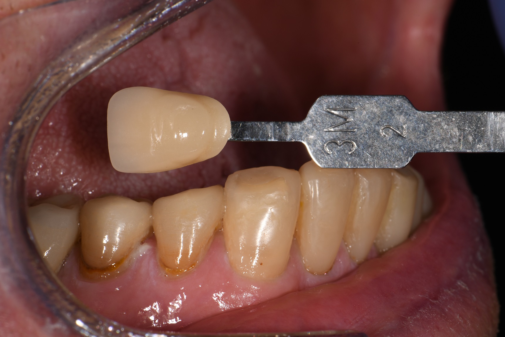 Crown Leakage with Replacement Required Crown Leakage with Replacement ...