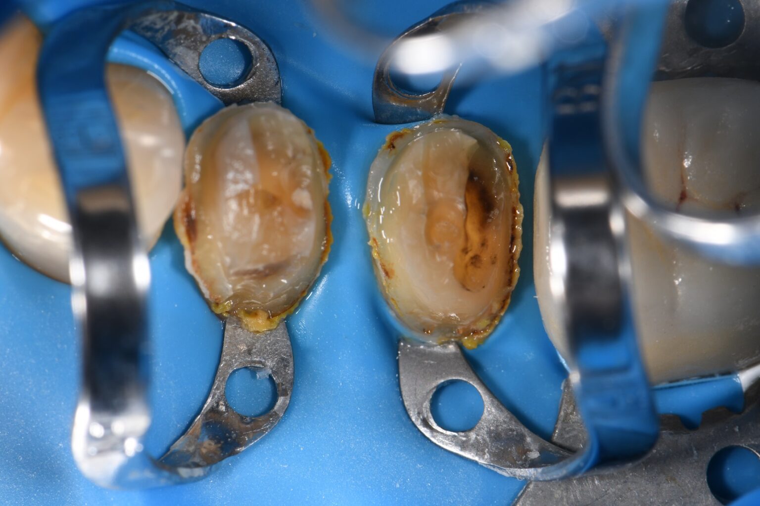 Crown Leakage with Replacement Required Crown Leakage with Replacement ...