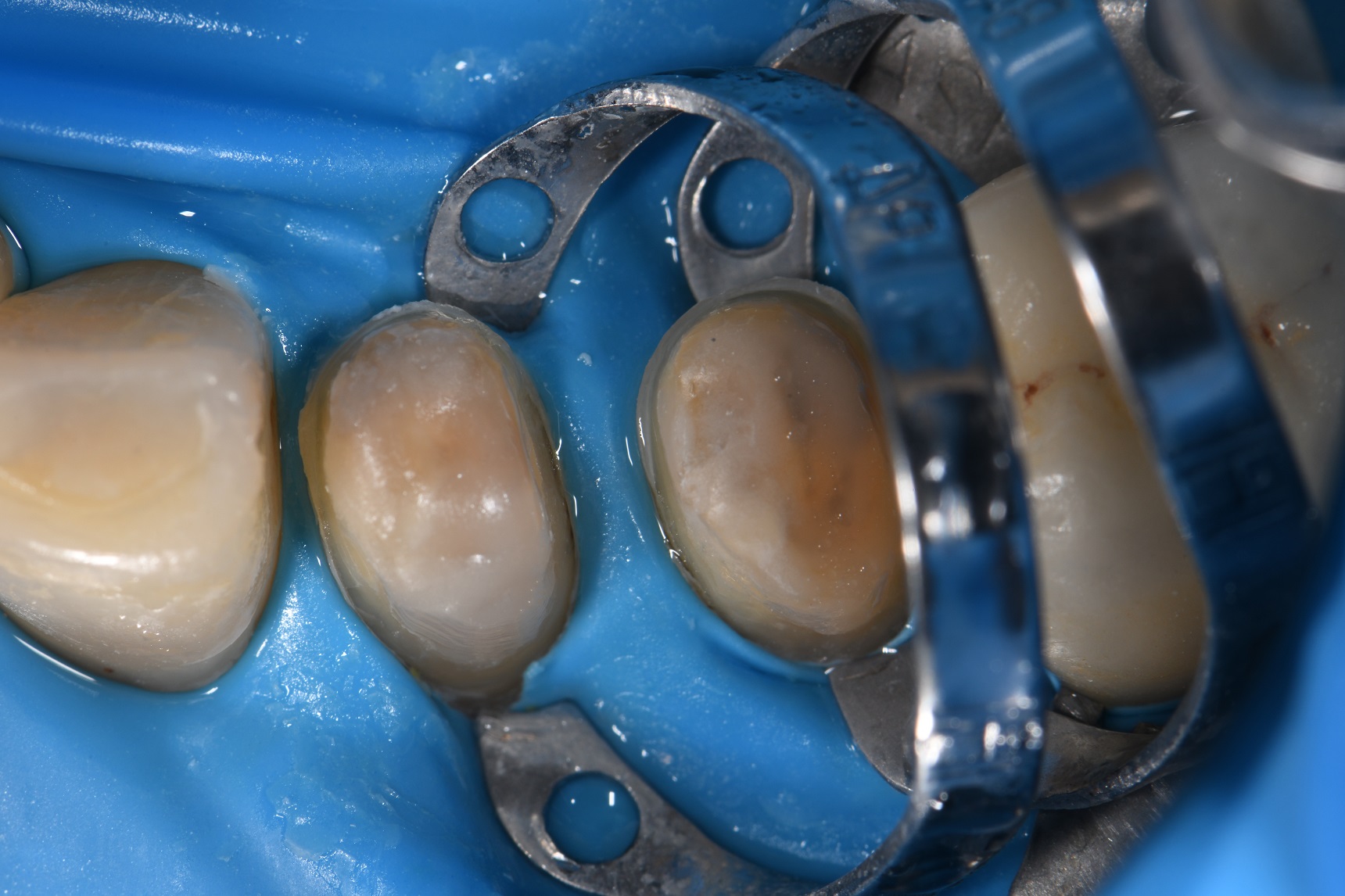 Crown Leakage with Replacement Required Crown Leakage with Replacement ...