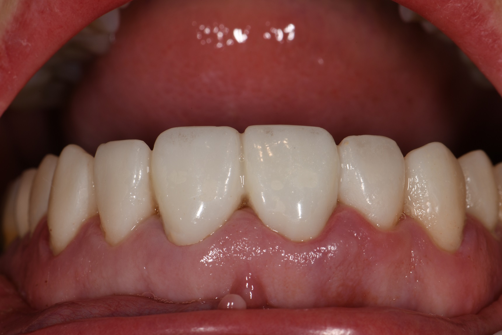 Porcelain Veneer Makeover Workflow Porcelain Veneer Makeover Workflow