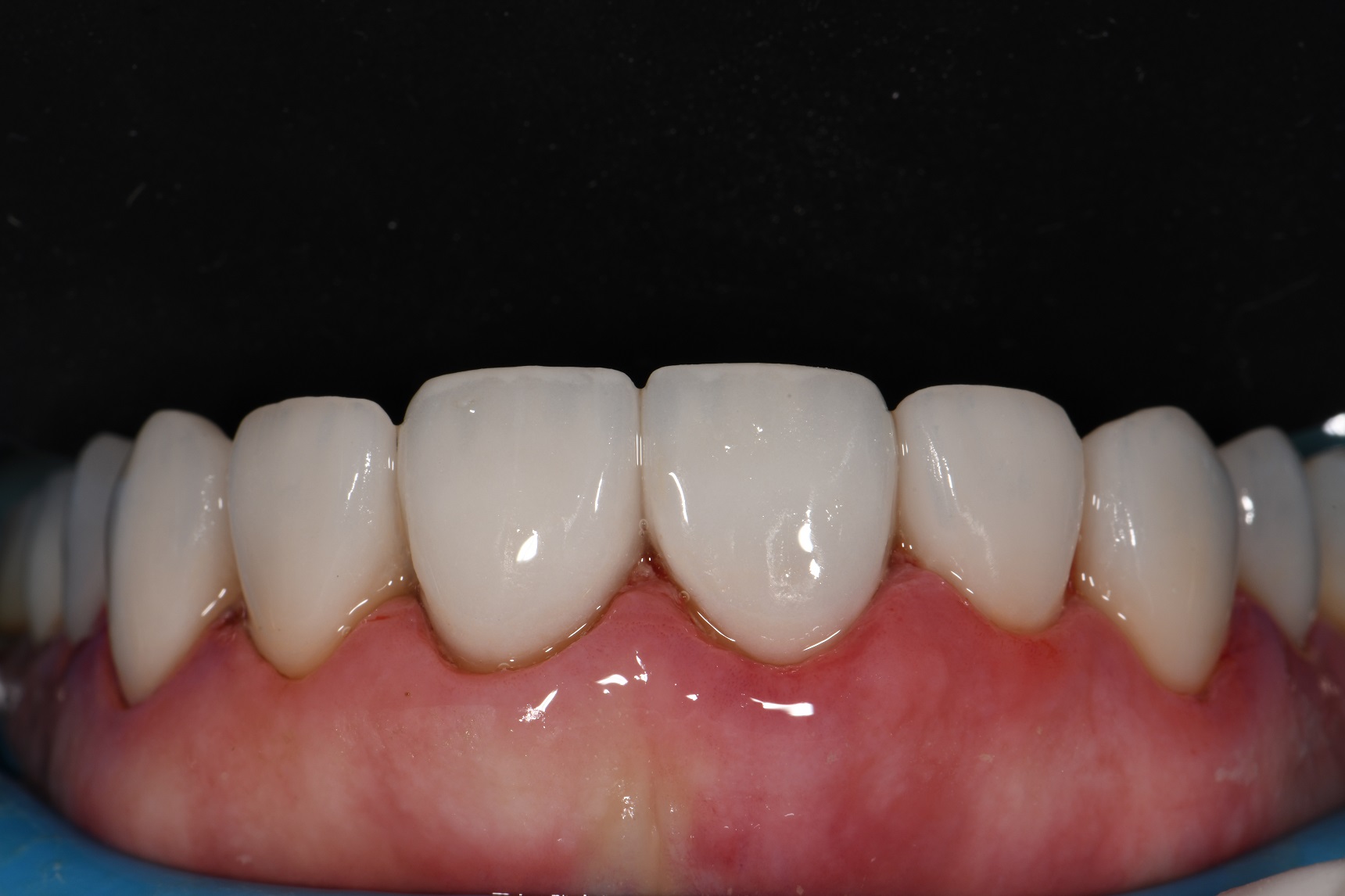 Porcelain Veneer Makeover Workflow Porcelain Veneer Makeover Workflow