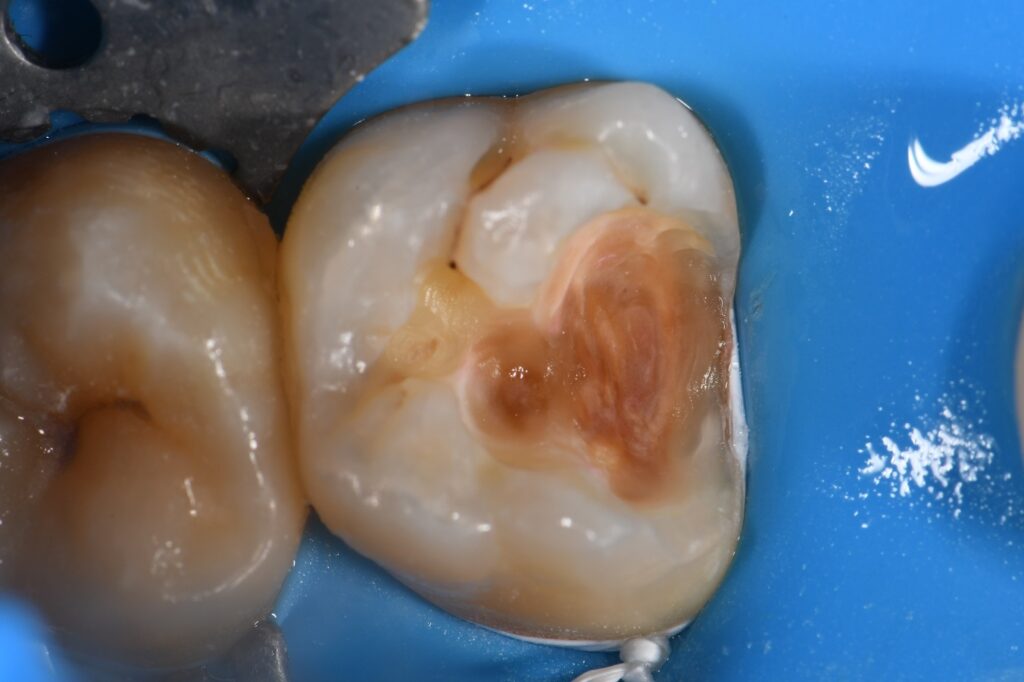 Complex reconstruction of a tooth Complex reconstruction of a tooth