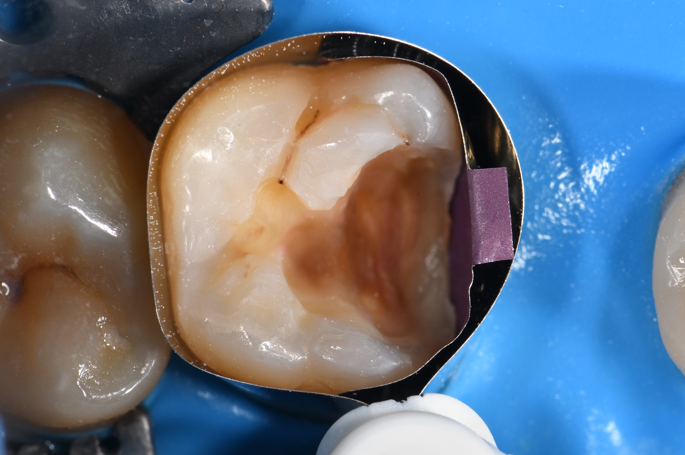 Complex reconstruction of a tooth Complex reconstruction of a tooth