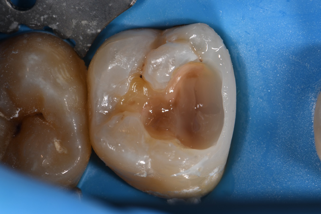 Complex reconstruction of a tooth Complex reconstruction of a tooth