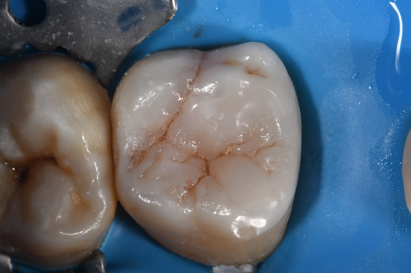 Complex reconstruction of a tooth Complex reconstruction of a tooth