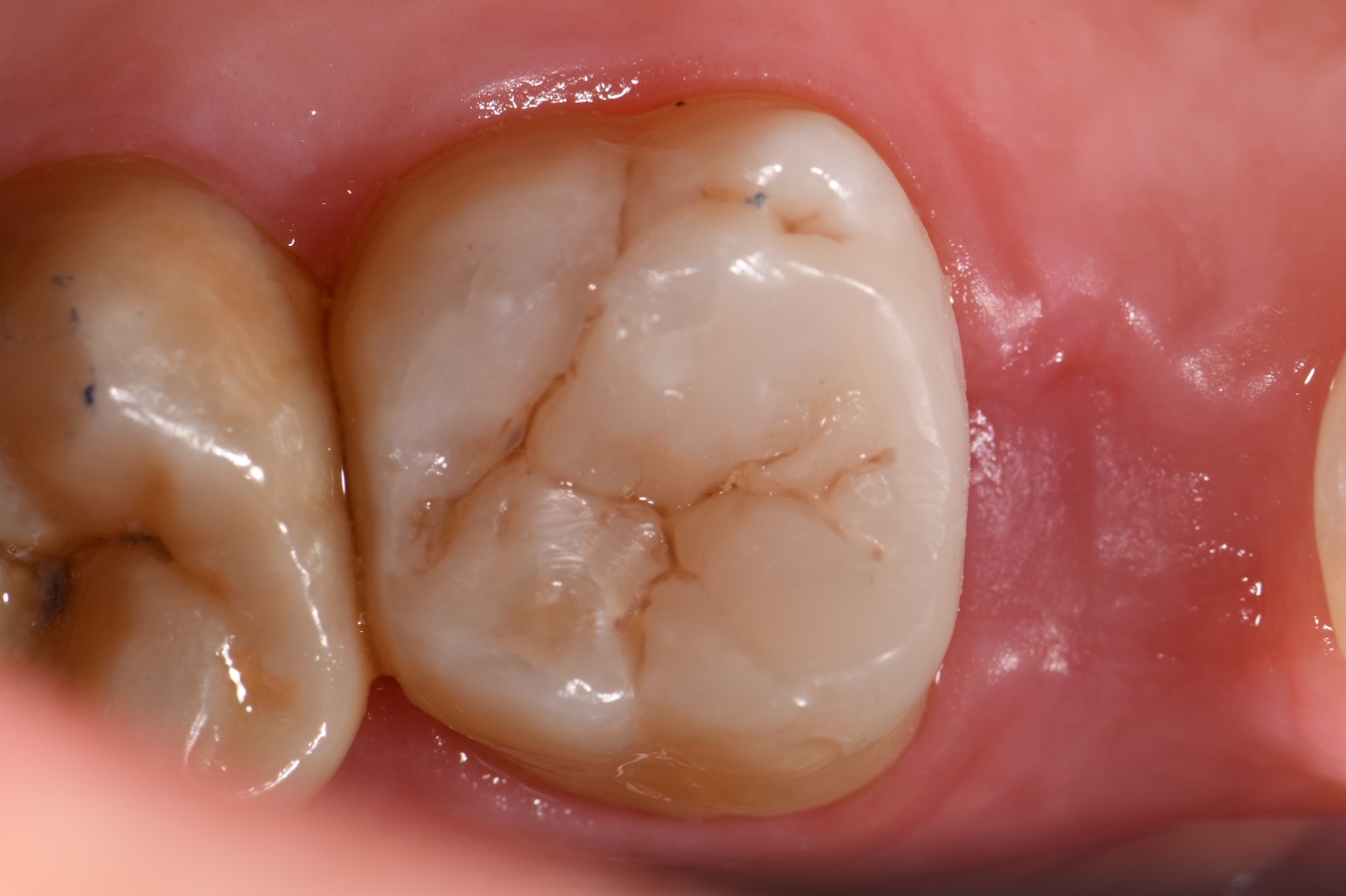 Complex reconstruction of a tooth Complex reconstruction of a tooth
