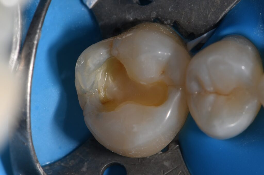 Composite Fillings Marginal Leakage and Failure Composite Fillings ...
