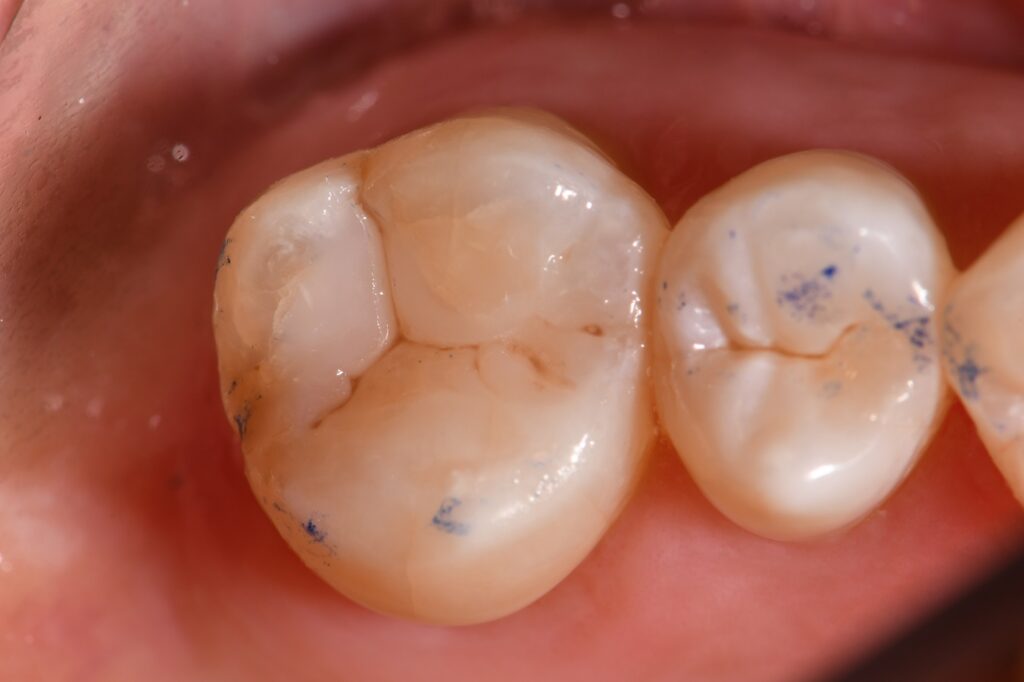 Composite Fillings Marginal Leakage and Failure Composite Fillings ...